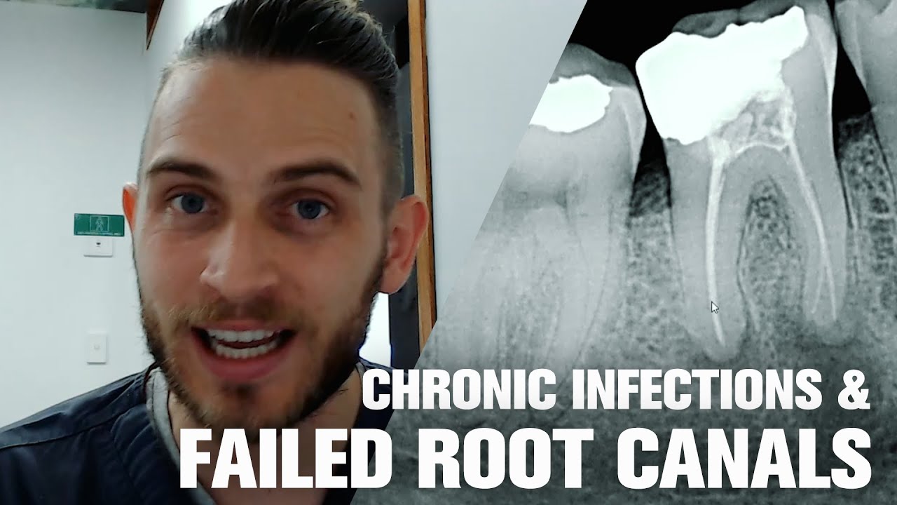Chronic Infections Gold Coast